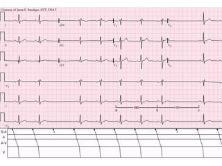 ECG Lecture: Sinus arrest, sinoatrial exit block, AV block and escape ...
