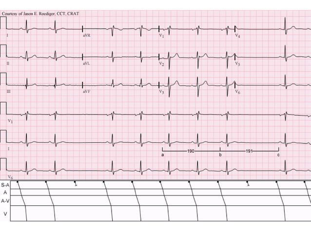 ECG Lecture: Sinus arrest, sinoatrial exit block, AV block and escape rhythms | PPT | Heart and ...