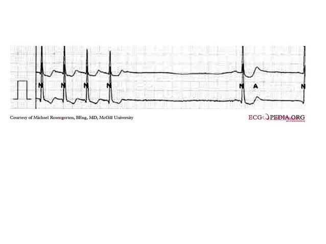 ECG Lecture: Sinus arrest, sinoatrial exit block, AV block and escape rhythms | PPT | Heart and ...