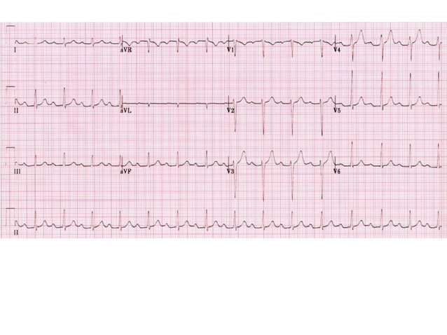 ECG Lecture: Sinus arrest, sinoatrial exit block, AV block and escape ...