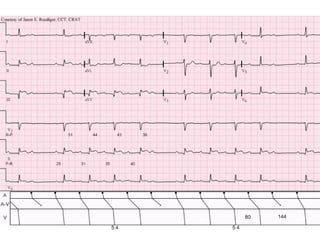 ECG Lecture: Sinus arrest, sinoatrial exit block, AV block and escape ...