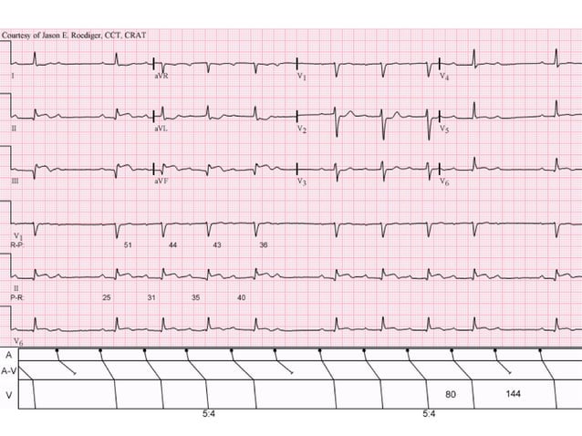 ECG Lecture: Sinus arrest, sinoatrial exit block, AV block and escape ...