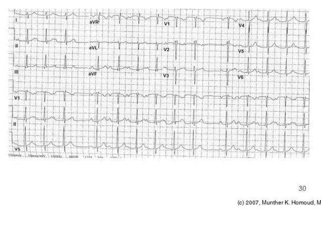 ECG Lecture: Sinus arrest, sinoatrial exit block, AV block and escape ...