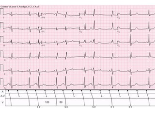 ECG Lecture: Sinus arrest, sinoatrial exit block, AV block and escape ...