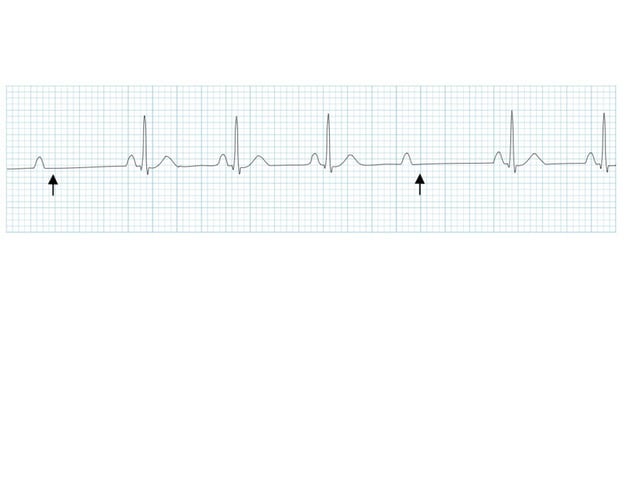 ECG Lecture: Sinus arrest, sinoatrial exit block, AV block and escape ...