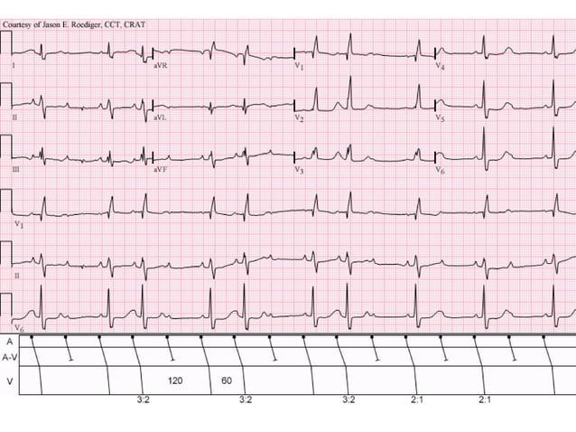 ECG Lecture: Sinus arrest, sinoatrial exit block, AV block and escape ...