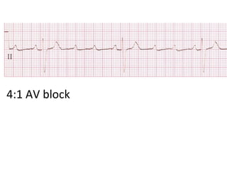ECG Lecture: Sinus arrest, sinoatrial exit block, AV block and escape ...