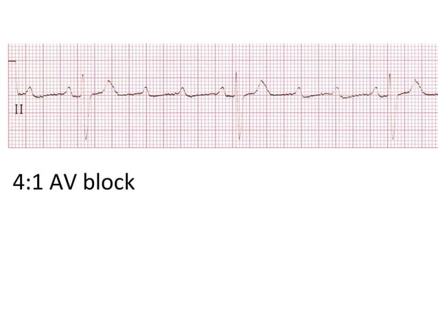 ECG Lecture: Sinus arrest, sinoatrial exit block, AV block and escape ...