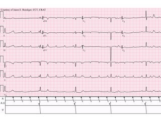 ECG Lecture: Sinus arrest, sinoatrial exit block, AV block and escape ...