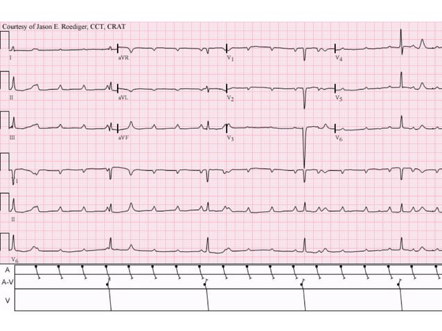 ECG Lecture: Sinus arrest, sinoatrial exit block, AV block and escape ...