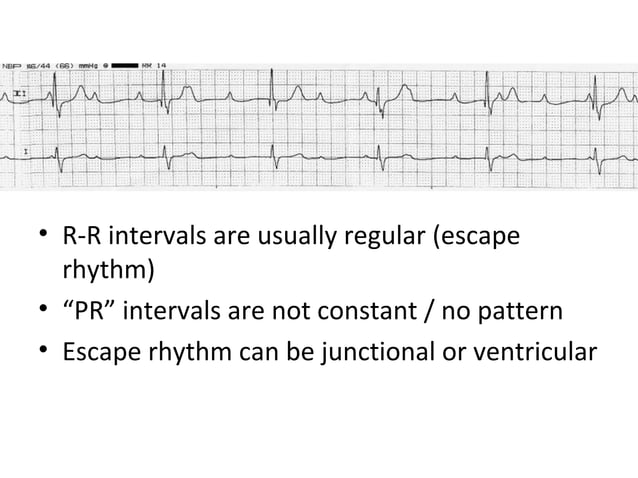 ECG Lecture: Sinus arrest, sinoatrial exit block, AV block and escape ...