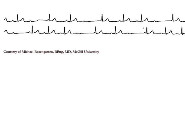 ECG Lecture: Sinus arrest, sinoatrial exit block, AV block and escape ...
