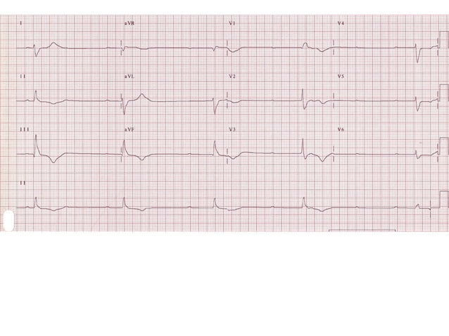 ECG Lecture: Sinus arrest, sinoatrial exit block, AV block and escape ...