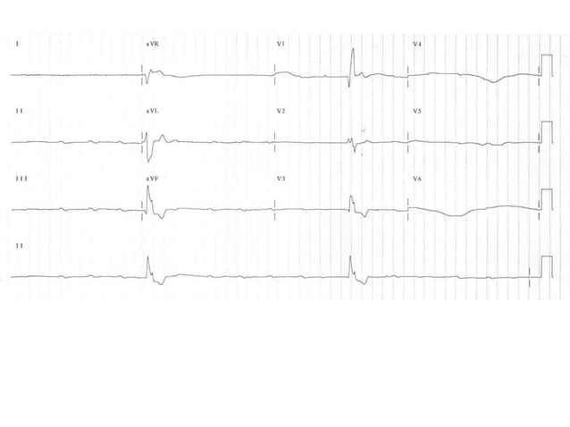 ECG Lecture: Sinus arrest, sinoatrial exit block, AV block and escape ...