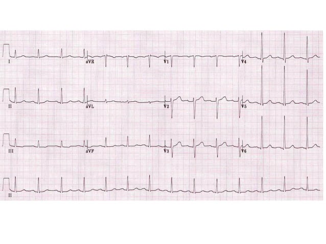 ECG Lecture: Sinus arrest, sinoatrial exit block, AV block and escape ...