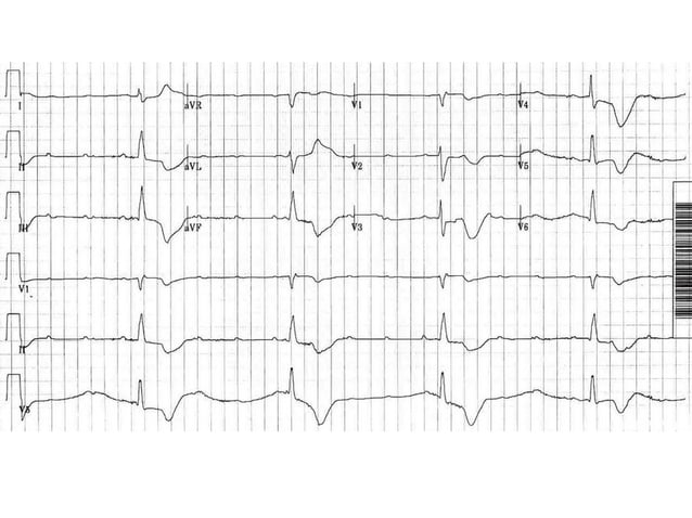 ECG Lecture: Sinus arrest, sinoatrial exit block, AV block and escape ...