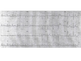 ECG Lecture: Sinus arrest, sinoatrial exit block, AV block and escape ...