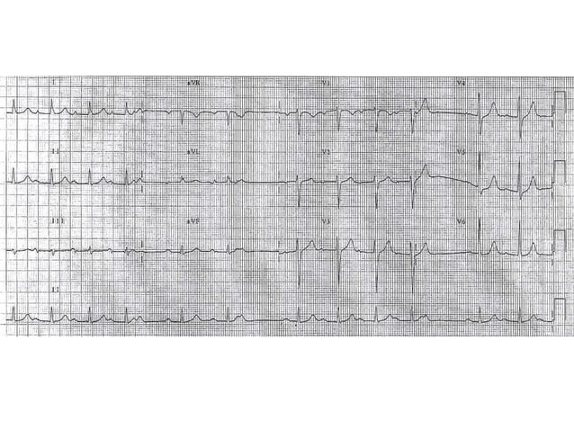 ECG Lecture: Sinus arrest, sinoatrial exit block, AV block and escape ...