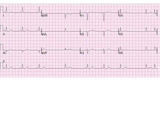 ECG Lecture: Sinus arrest, sinoatrial exit block, AV block and escape ...
