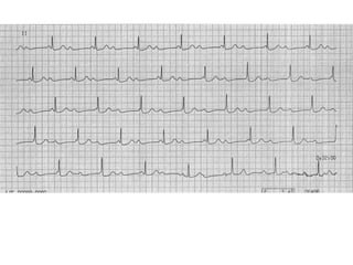 ECG Lecture: Sinus arrest, sinoatrial exit block, AV block and escape ...