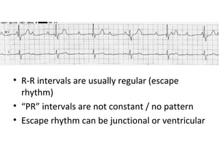 ECG Lecture: Sinus arrest, sinoatrial exit block, AV block and escape ...
