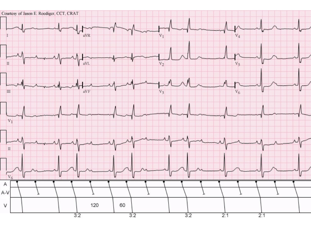 ECG Lecture: Sinus arrest, sinoatrial exit block, AV block and escape…