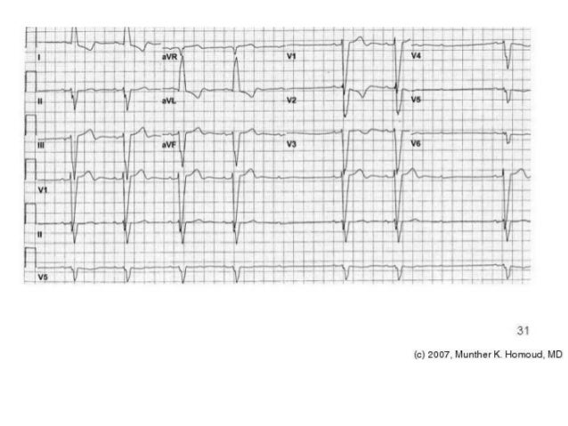 ECG Lecture: Sinus arrest, sinoatrial exit block, AV block and escape…