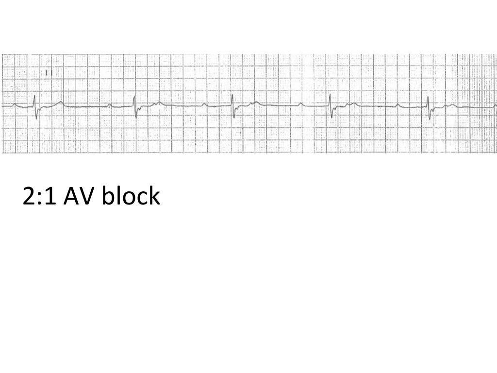 ECG Lecture: Sinus arrest, sinoatrial exit block, AV block and escape…