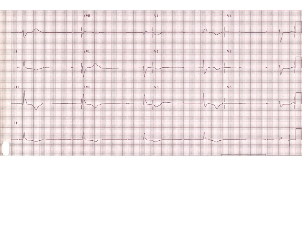 ECG Lecture: Sinus arrest, sinoatrial exit block, AV block and escape…