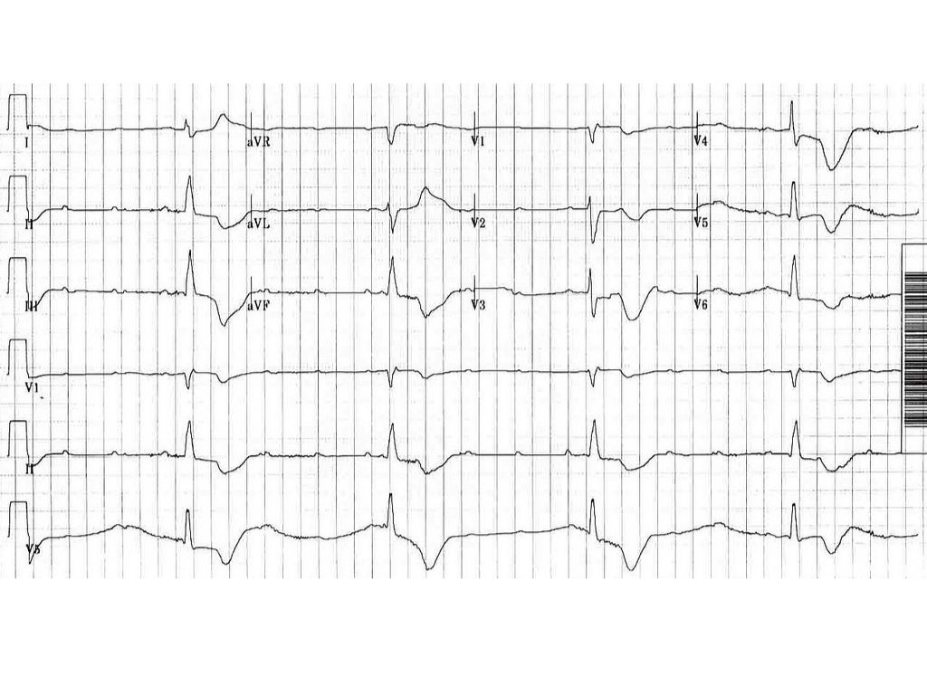 ECG Lecture: Sinus arrest, sinoatrial exit block, AV block and escape…