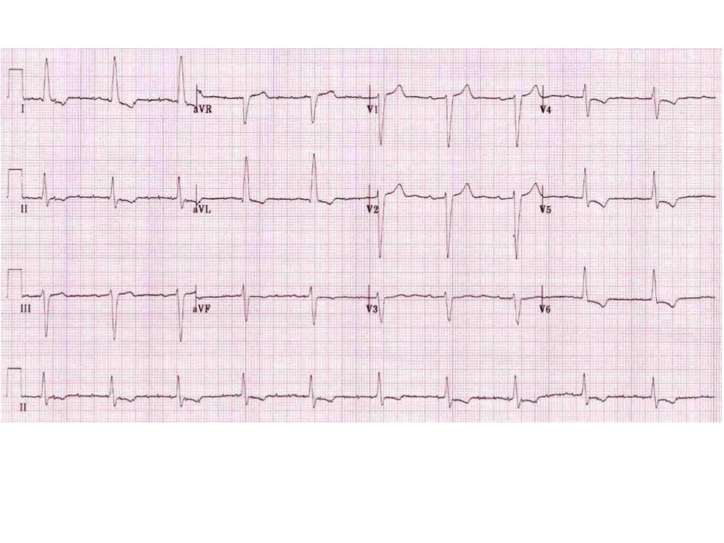 ECG Lecture: Sinus arrest, sinoatrial exit block, AV block and escape…