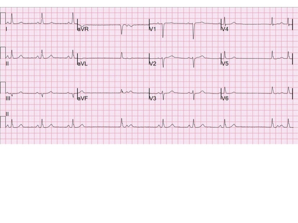 ECG Lecture: Sinus arrest, sinoatrial exit block, AV block and escape…