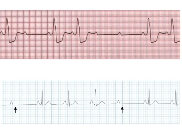 ECG Lecture: Sinus arrest, sinoatrial exit block, AV block and escape…