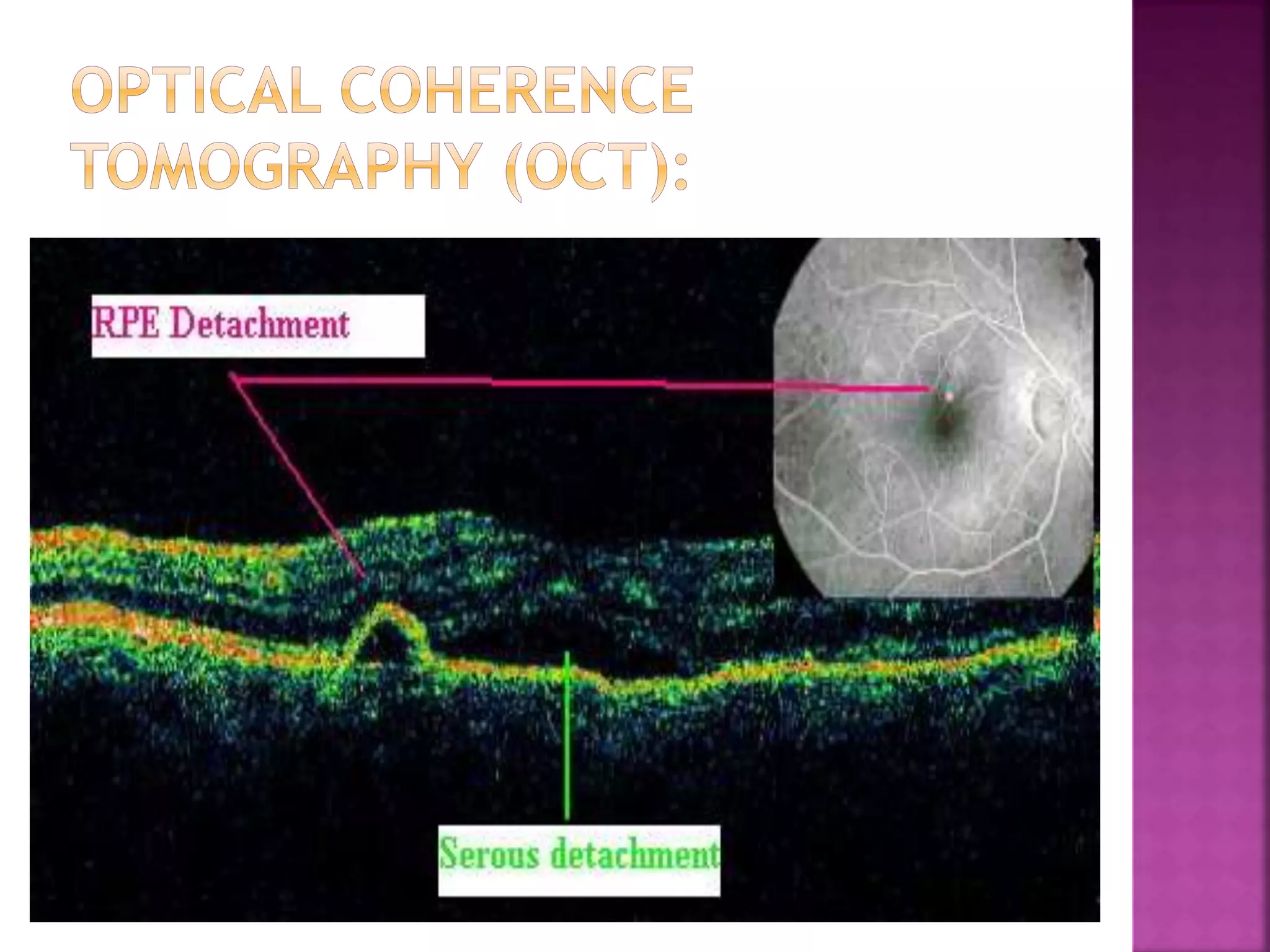 central serous chorioretinopathy | PPTX