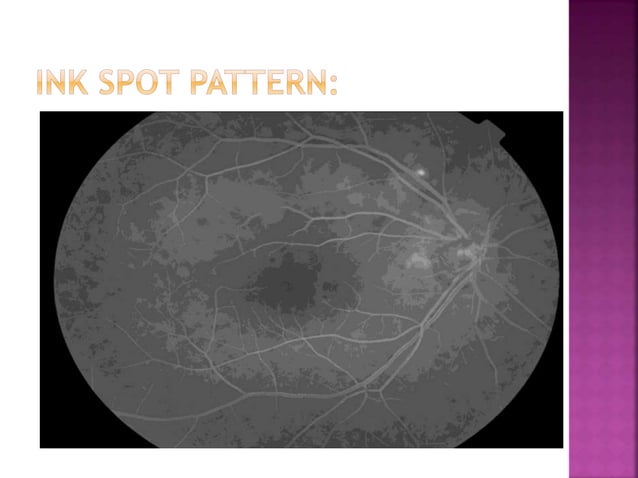 central serous chorioretinopathy | PPTX | Eye and Vision Conditions ...