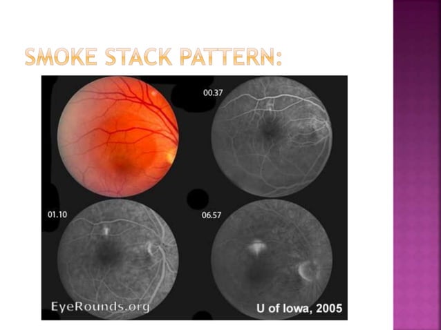 central serous chorioretinopathy | PPTX | Eye and Vision Conditions ...