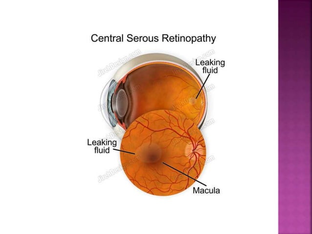 central serous chorioretinopathy | PPTX | Eye and Vision Conditions ...