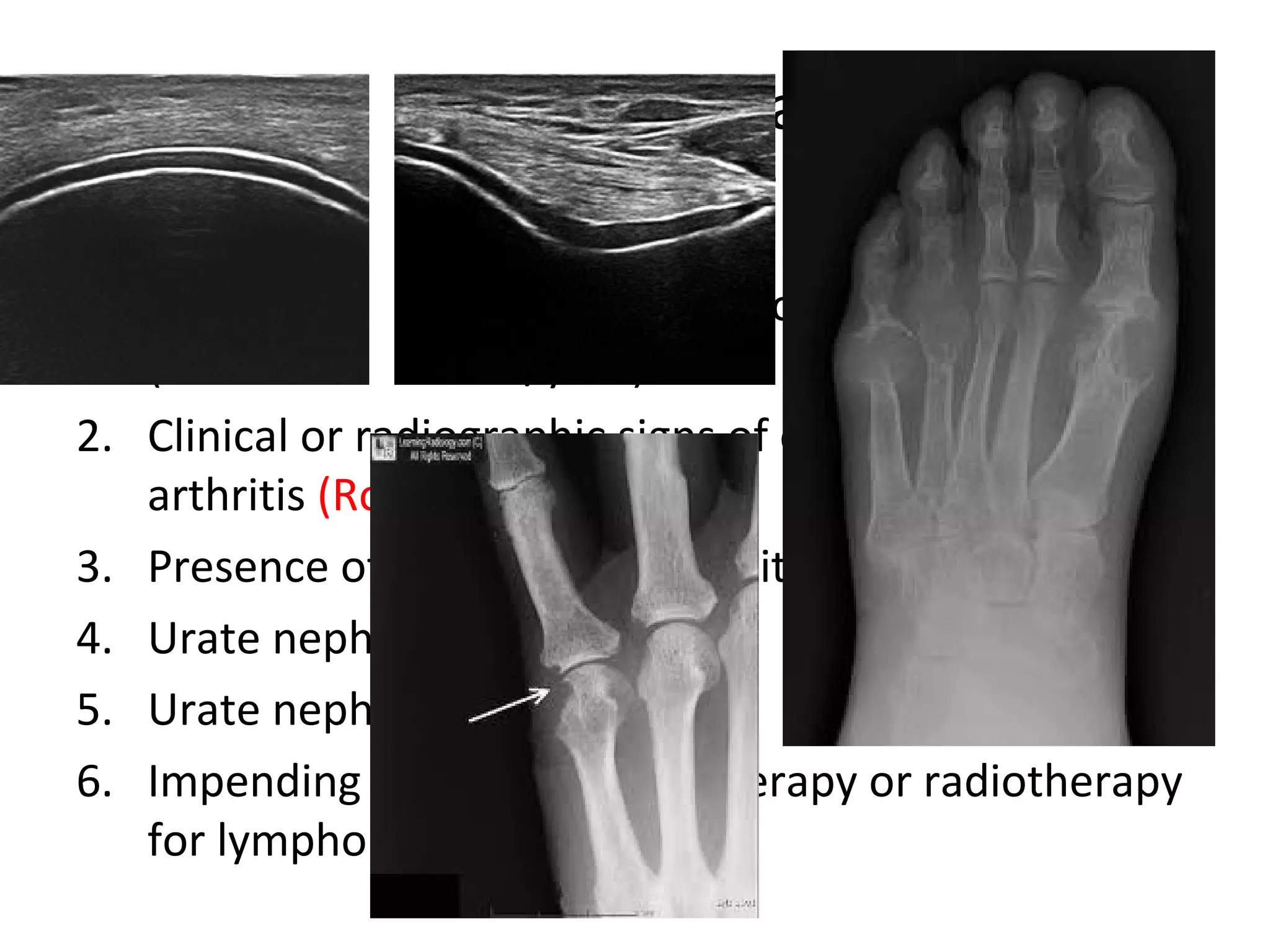 Sabah ( Malaysia) rheumatology update gout 2016 | PPT