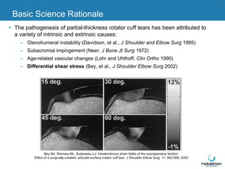 Sab basic science and partial thickness clinical slide deck | PPTX