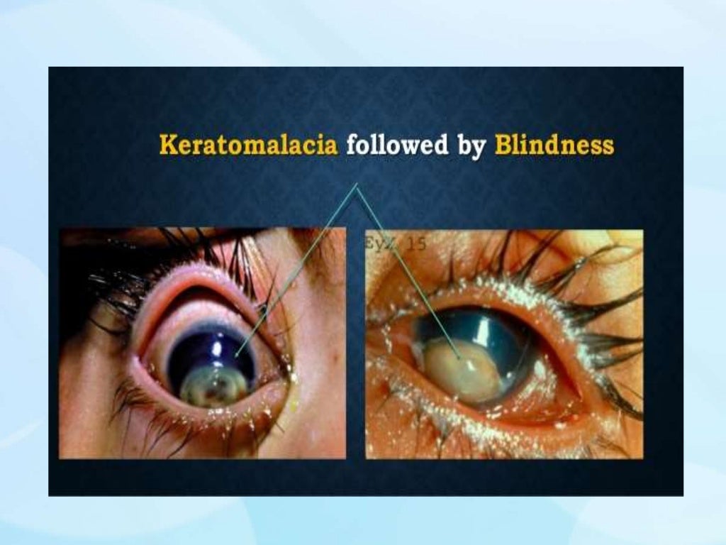 vision biochemistry, role of vitamin A and xerophthalmia