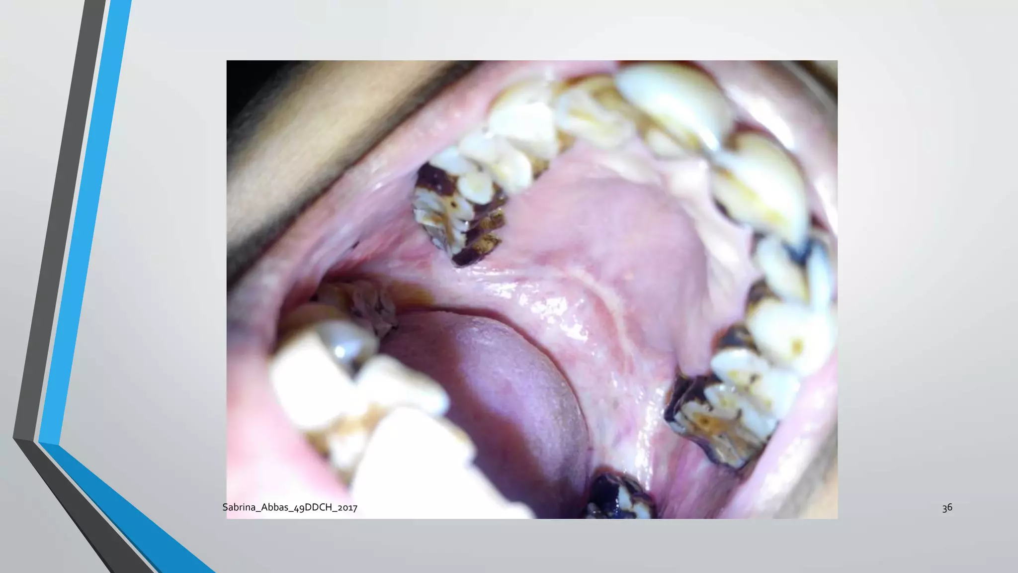 Oral Sub-mucous Fibrosis : A Precancerous Lesion | PPTX | Dental Health ...