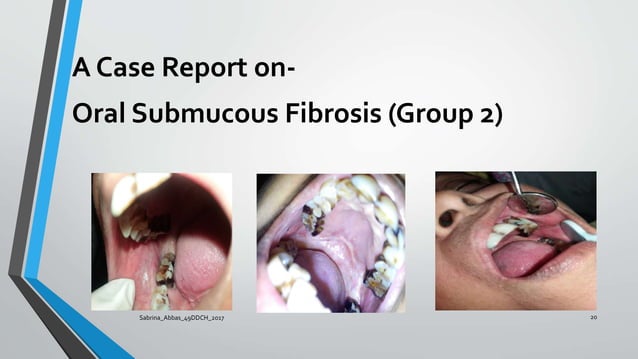 Oral Sub-mucous Fibrosis : A Precancerous Lesion | PPTX | Dental Health ...