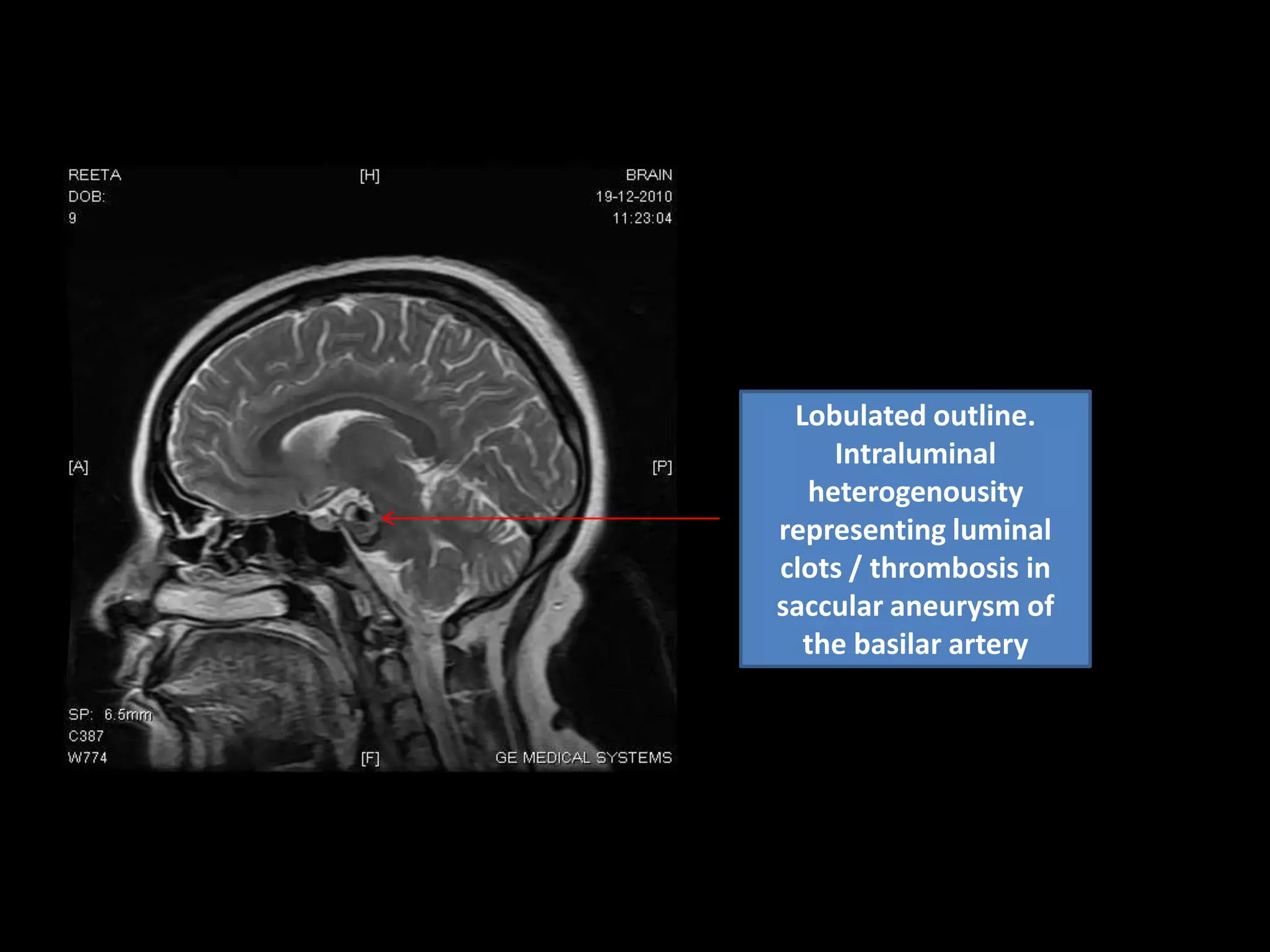 Saccular aneurysm of basilar artery | PPTX | Brain and Nervous System ...