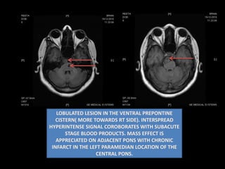 Saccular aneurysm of basilar artery | PPT