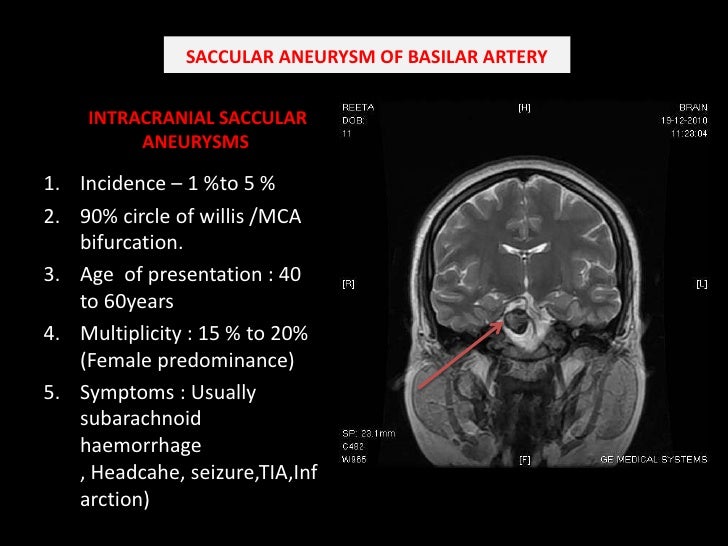 Saccular aneurysm of basilar artery Saccular aneurysm of basilar artery