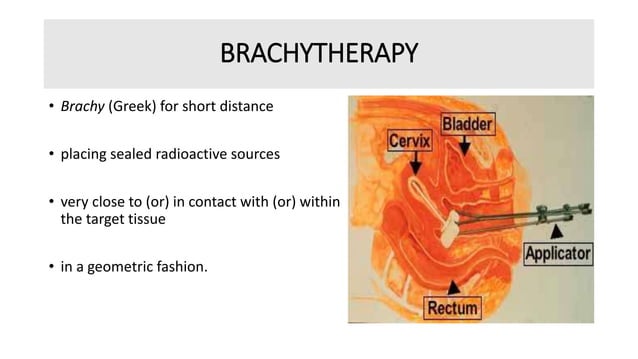Brachytherapy in carcinoma cervix - history to present | PPTX | Medical ...
