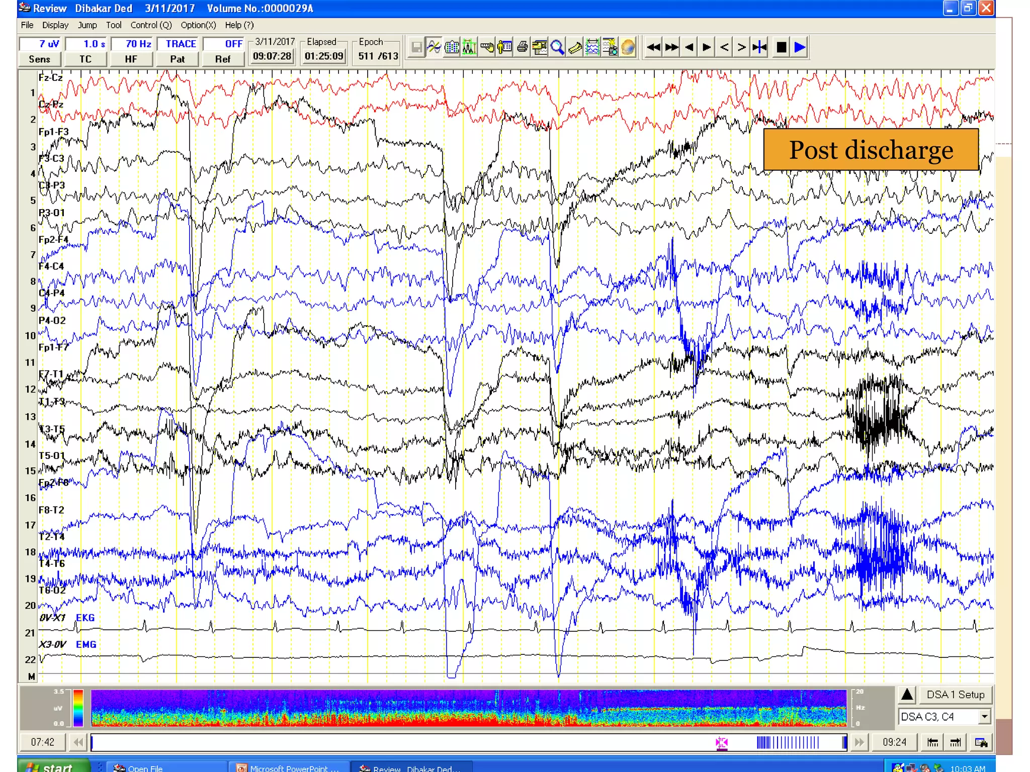 normal eeg | PPTX