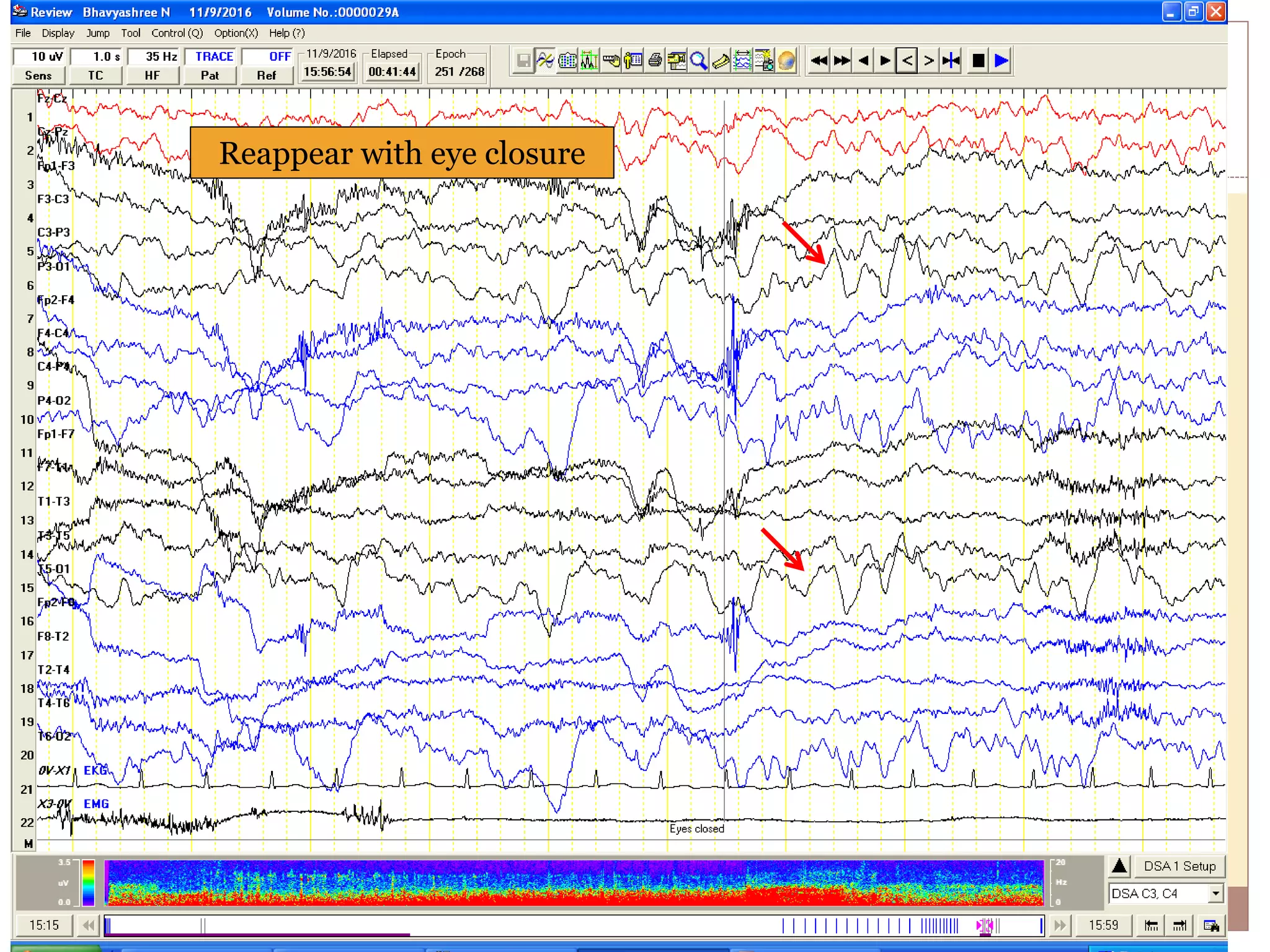 normal eeg | PPTX