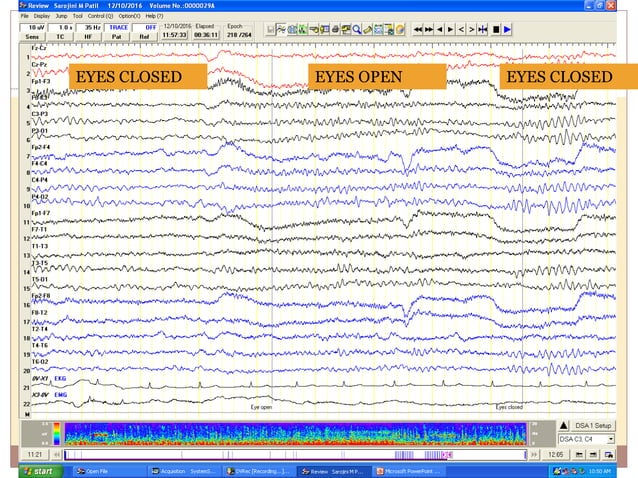 normal eeg