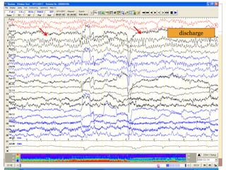 Normal Eeg Vs Abnormal Eeg